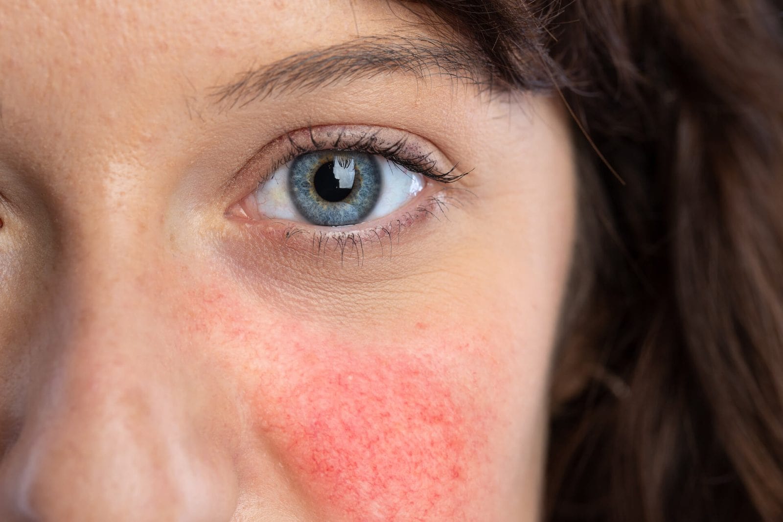 Understanding Rosacea: Symptoms, Causes, and Treatment Options ...