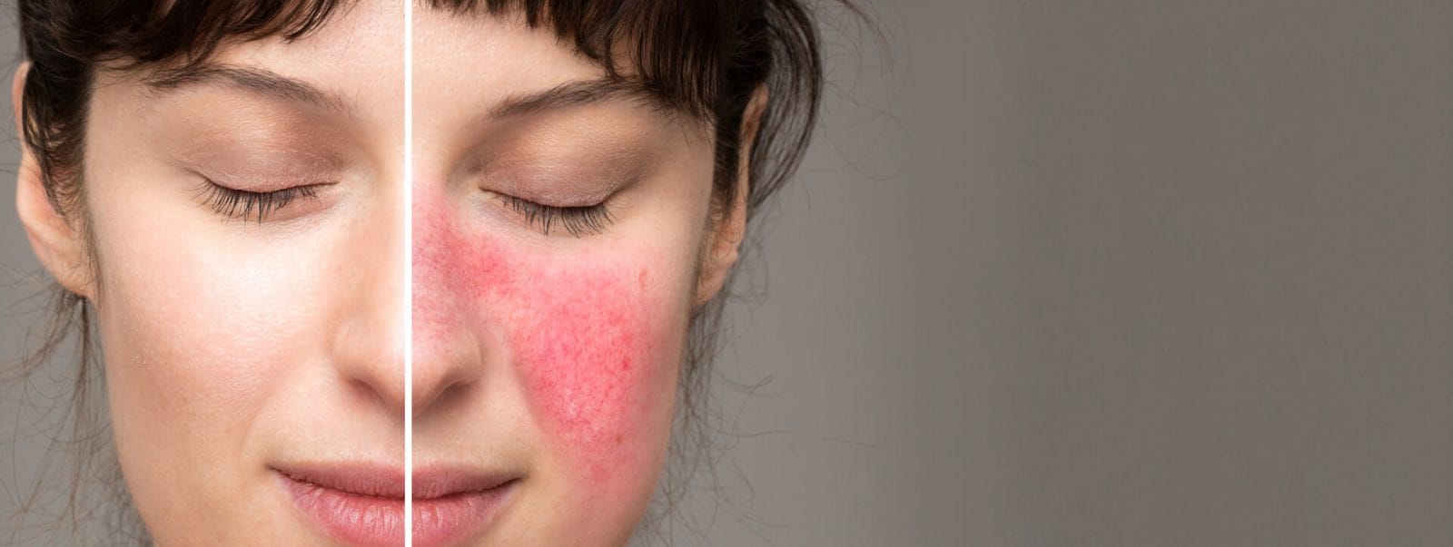 10 Skincare Tips for Managing Rosacea Flares - SkinAddict.co.uk