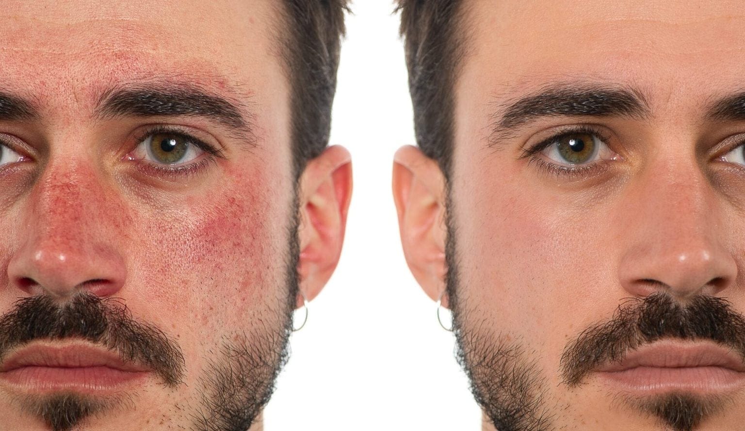 The Do's and Don'ts of Skincare for Rosacea - SkinAddict.co.uk